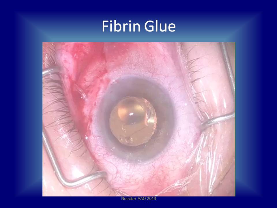 Molteno® - ISP Surgical