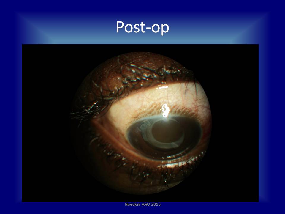 Molteno® - ISP Surgical