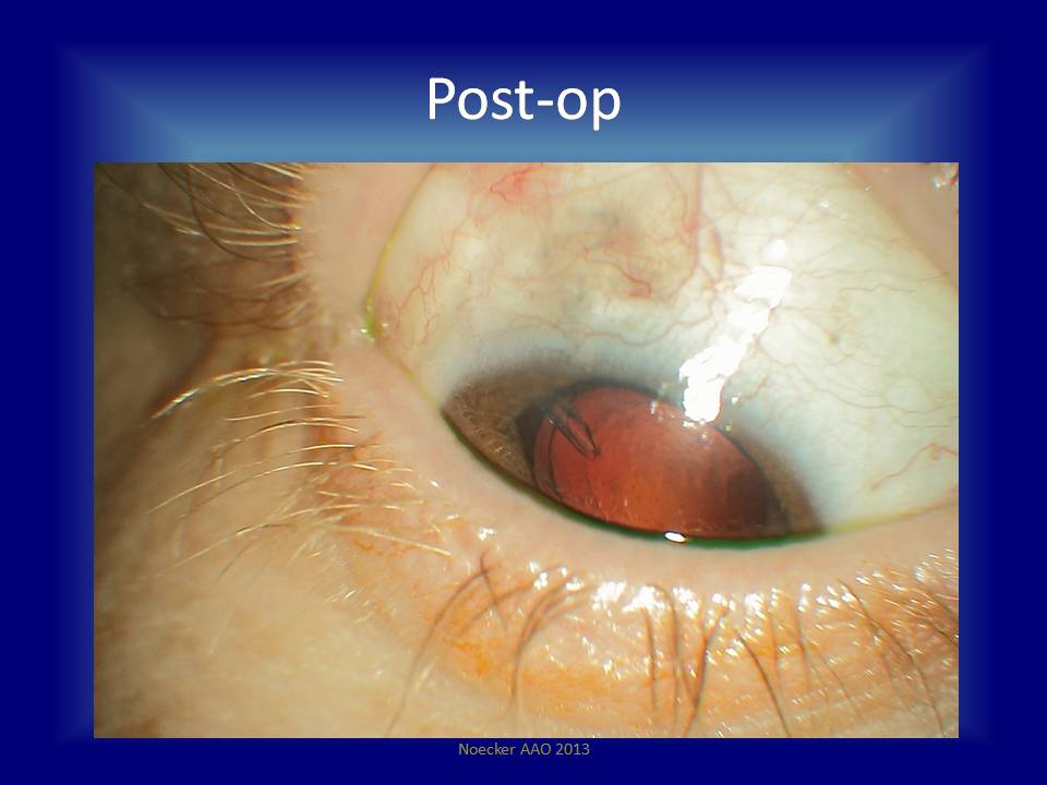 Molteno® - ISP Surgical